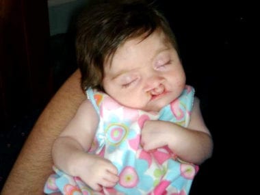 From Undiagnosed to Bohring-Opitz Syndrome: Finding Our Crew ...