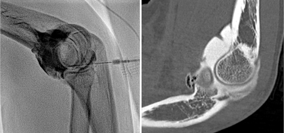 Arthrogram for MRI or CT - Cincinnati Children's Blog