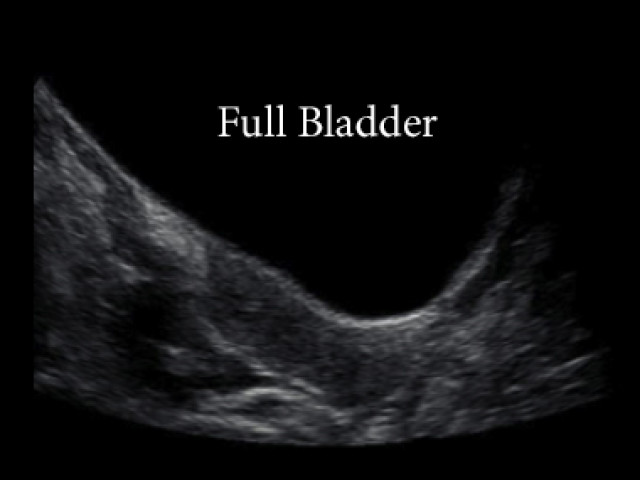 Ultrasounds and Bladders: What's the Connection? - Cincinnati Children ...