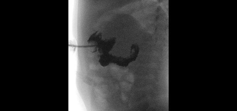 What is Intestinal Malrotation and Volvulus? - Cincinnati Children's Blog